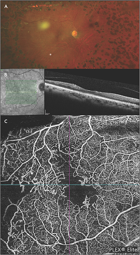 Retinal Physician | PentaVision