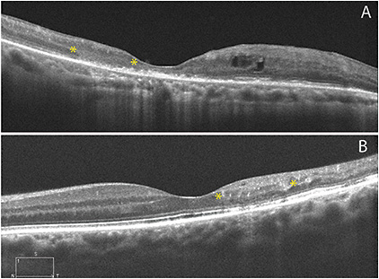 Retinal Physician | PentaVision