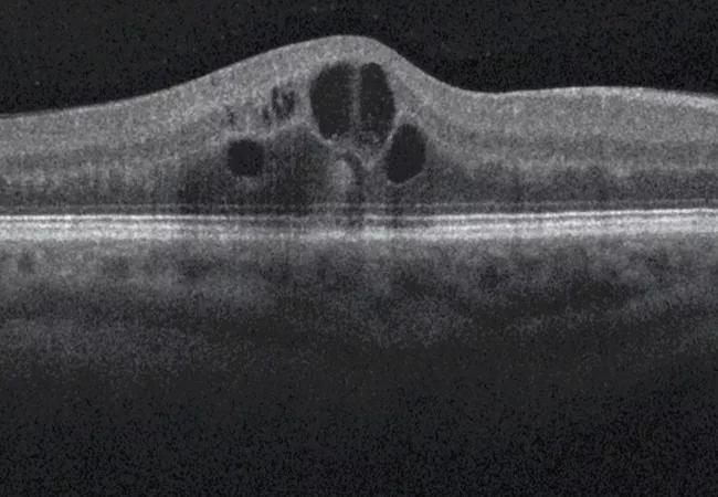 OCT Biomarkers Predict Anti-VEGF Failure in DME | Retinal Physician
