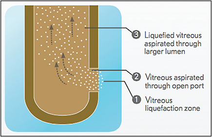 Retinal Physician | PentaVision