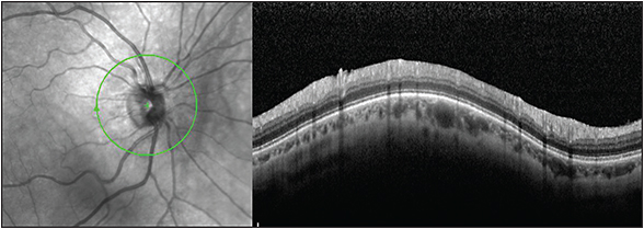 Retinal Physician | PentaVision