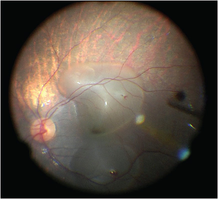 Retinal Physician | PentaVision