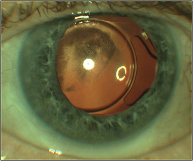 Retinal Physician | PentaVision
