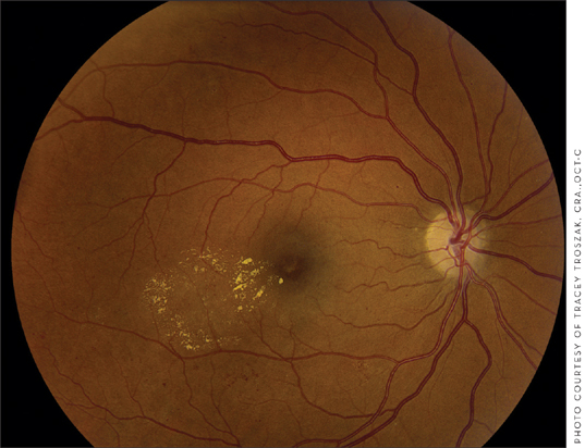 Retinal Physician | PentaVision