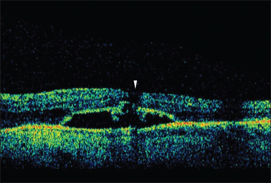 Retinal Physician | PentaVision