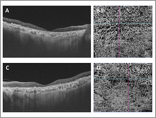 Retinal Physician | PentaVision