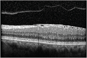 Retinal Physician | PentaVision