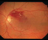 Retinal Physician | PentaVision