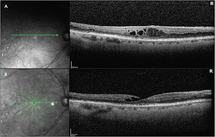 Retinal Physician | PentaVision