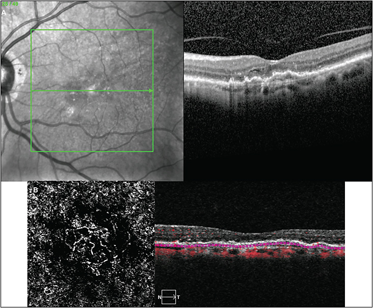 Retinal Physician | PentaVision