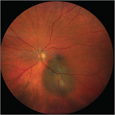 Retinal Physician | PentaVision