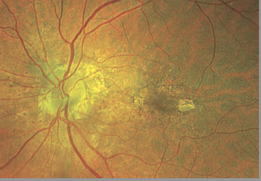 ApoM Pathway May Offer New Target for Early AMD Intervention | Retinal ...