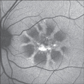 Retinal Physician | PentaVision