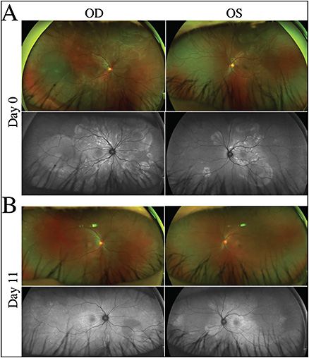 Retinal Physician | PentaVision