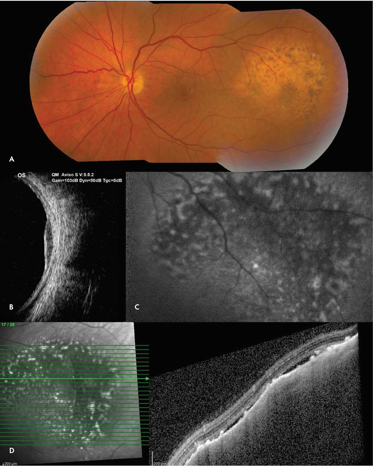 Best Practices Regarding Choroidal Nevus Follow-up | Retinal Physician