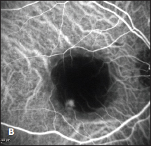 Retinal Physician | PentaVision