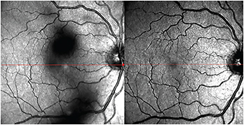 Retinal Physician | PentaVision