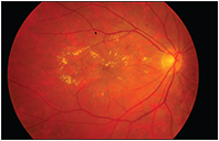 Retinal Physician | PentaVision