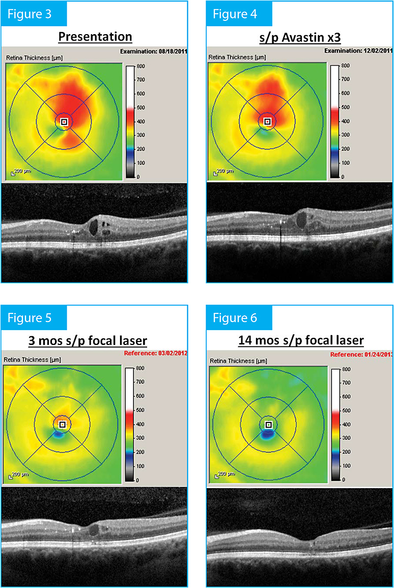 Retinal Physician | PentaVision