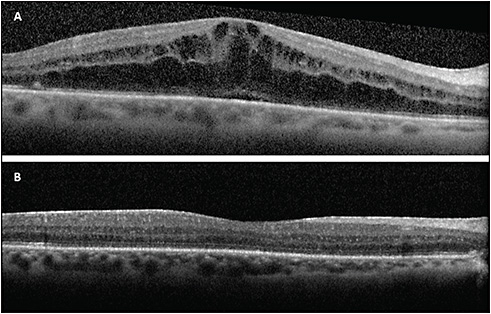 Retinal Physician | PentaVision