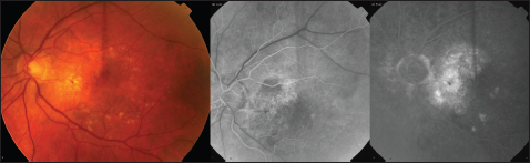 Retinal Physician | PentaVision