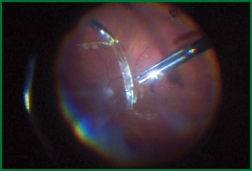 Retinal Physician | PentaVision