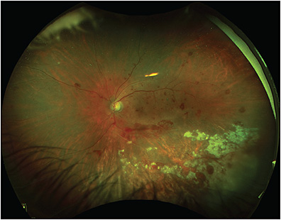 Retinal Physician | PentaVision