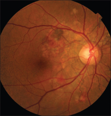 Retinal Physician | PentaVision