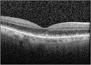 Retinal Physician | PentaVision