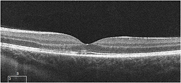 Retinal Physician | PentaVision
