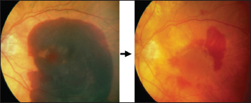 Retinal Physician | PentaVision