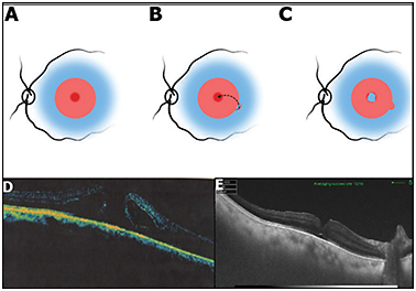 Retinal Physician | PentaVision