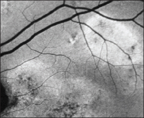 Retinal Physician | PentaVision