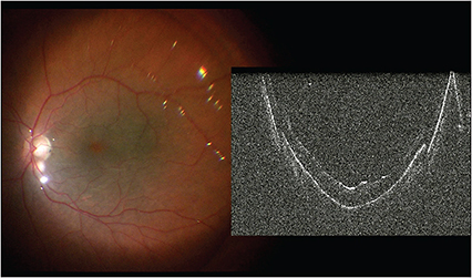 Retinal Physician | PentaVision