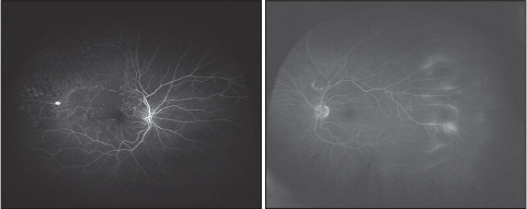 Retinal Physician | PentaVision
