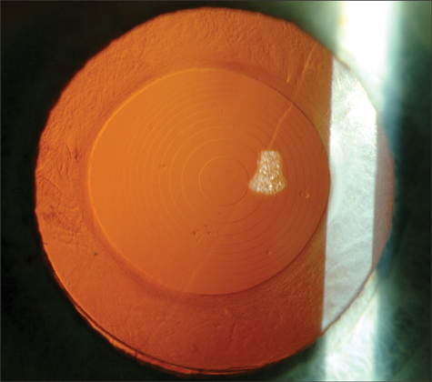 Retinal Physician | PentaVision