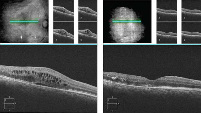 Retinal Physician | PentaVision