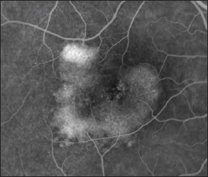 Retinal Physician | PentaVision