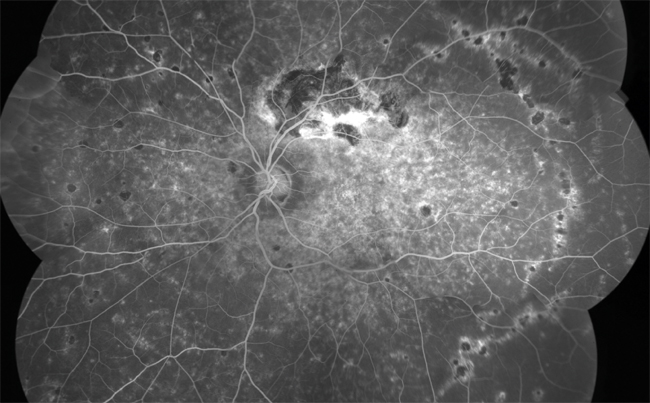 Retinal Physician | PentaVision