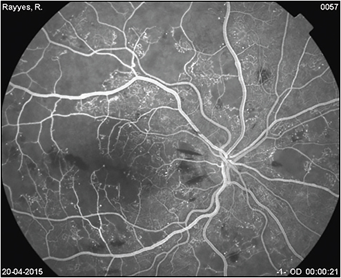 Retinal Physician | PentaVision