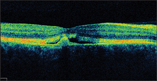 Retinal Physician | PentaVision