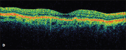 Retinal Physician | PentaVision