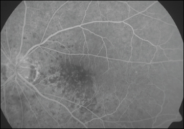 Retinal Physician | PentaVision