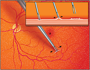 Retinal Physician | PentaVision
