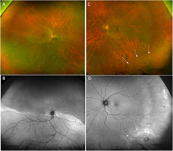 Retinal Physician | PentaVision