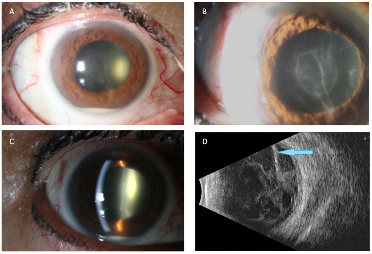 Endophthalmitis Then and Now | Retinal Physician