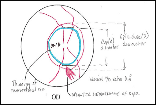 Retinal Physician | PentaVision