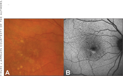 Retinal Physician | PentaVision