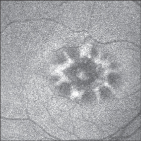 Retinal Physician | PentaVision