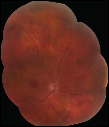 Retinal Physician | PentaVision